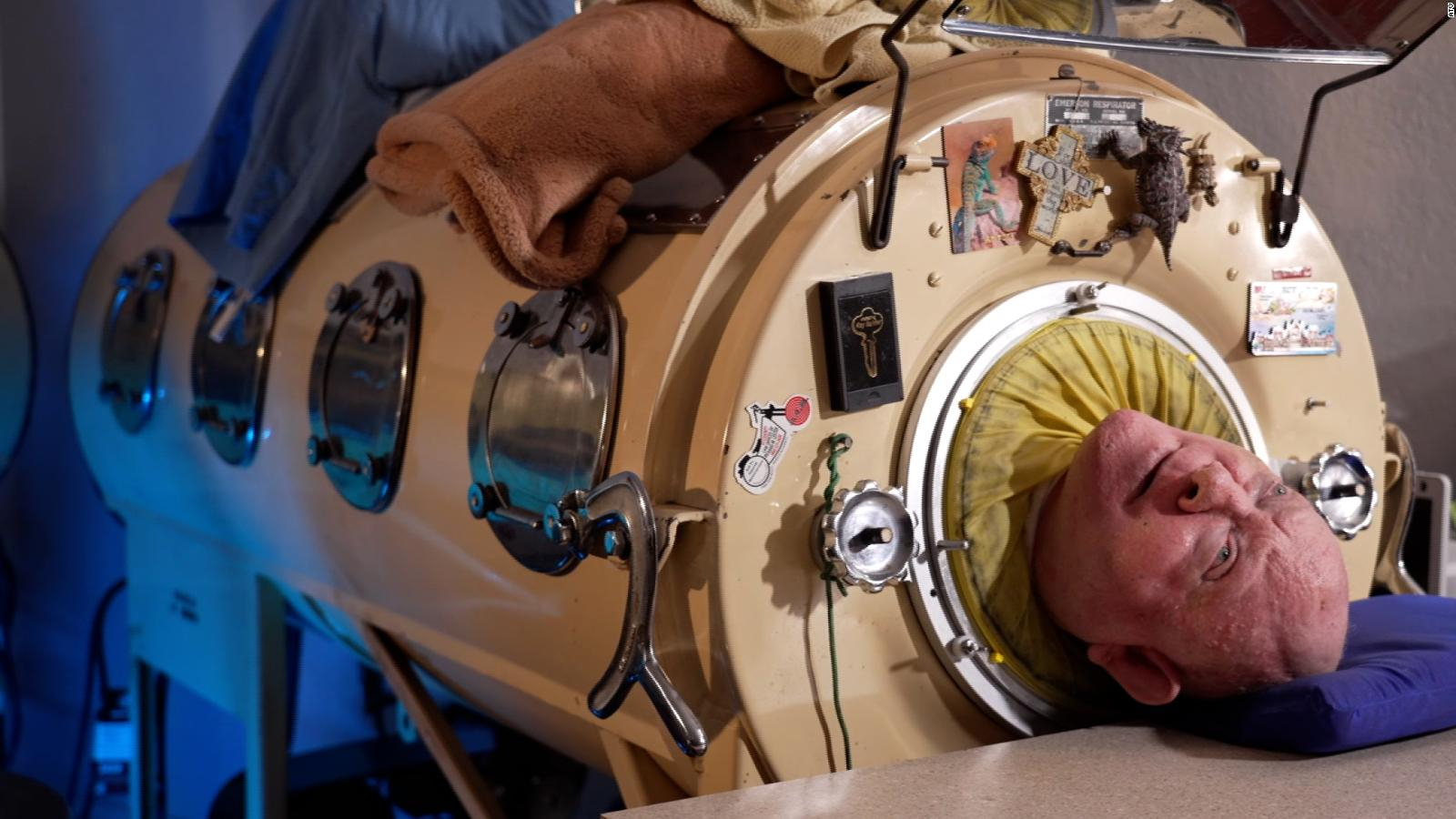 Murió el hombre que vivió 70 años en un pulmón de acero - Doral Voice